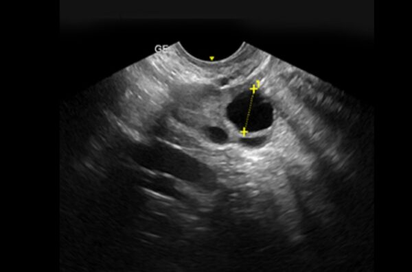Follicular Monitoring in Hyderabad | RYAN Scan
